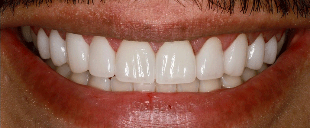 Smile Gallery - Winter Dental - Dentist Arvada, CO