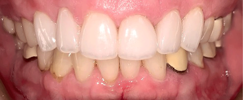 Smile Gallery - Winter Dental - Dentist Arvada, CO